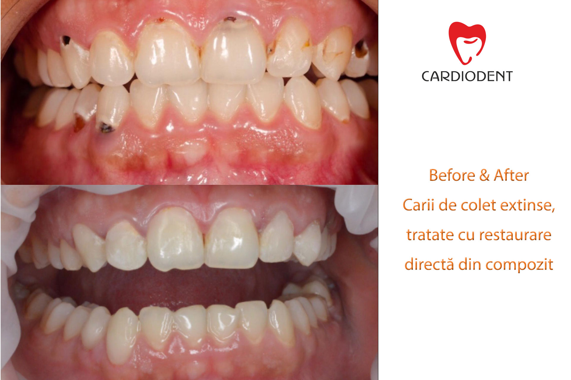 Tratamentul cariei dentare – diferența dintre obturații și incrustații ...