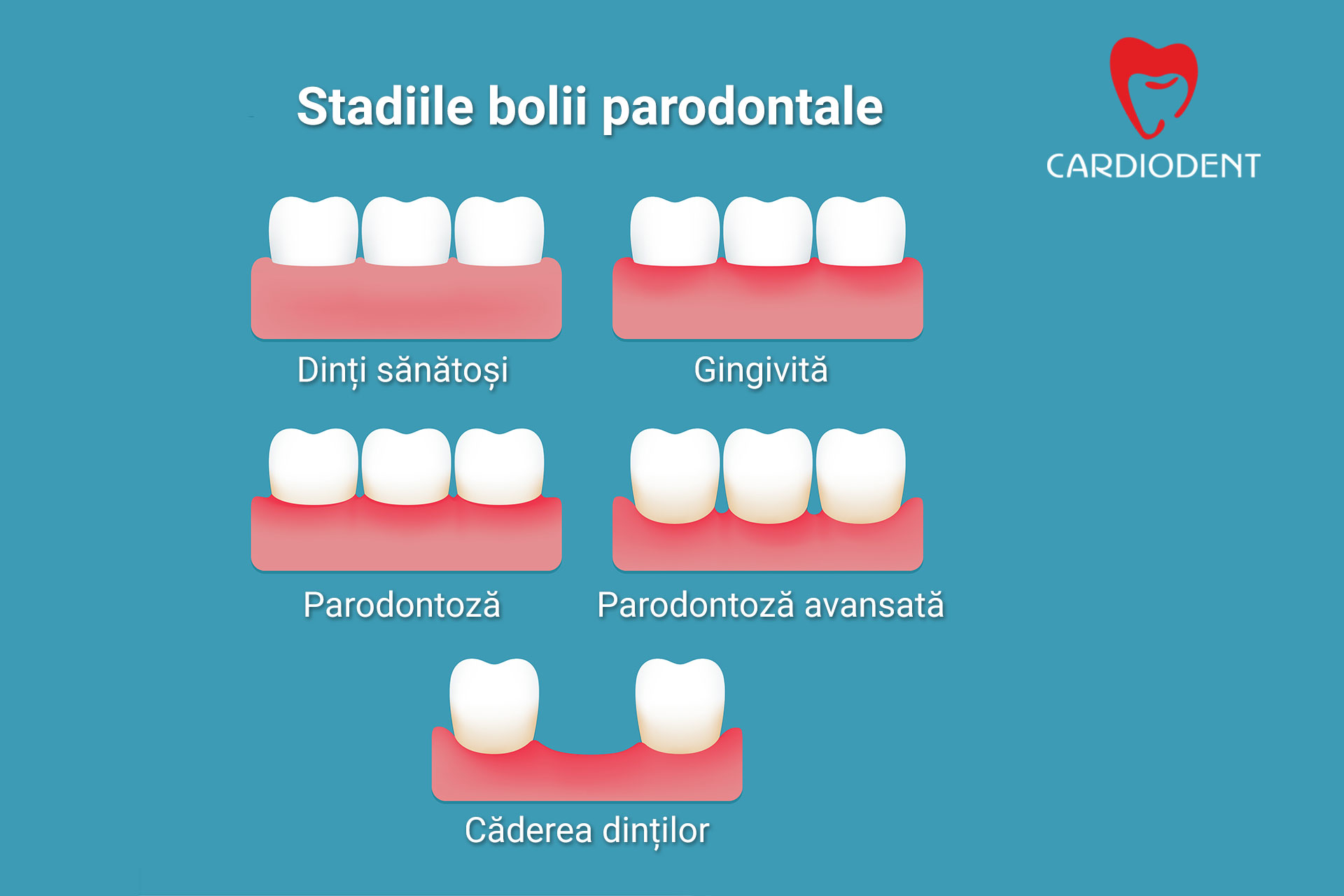 Boala parodontală (Parodontoza) – cauze, prevenție și tratamente ...